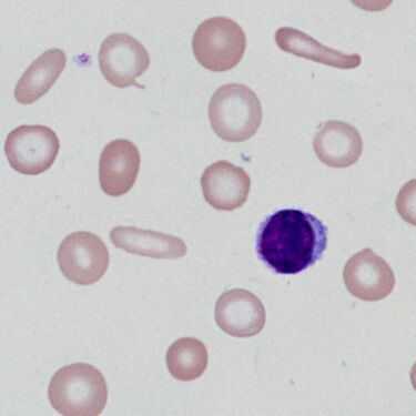 Pencil cells - haematologyetc.co.uk