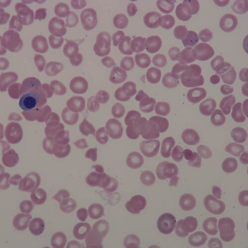 Agglutination - haematologyetc.co.uk