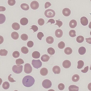 Fragmented cells - haematologyetc.co.uk