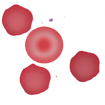 Irregularly contracted cells - haematologyetc.co.uk