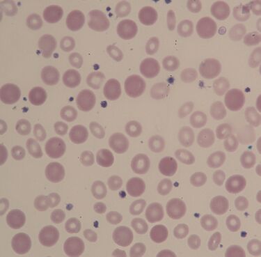 Dimorphic - haematologyetc.co.uk