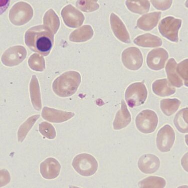 Irregularly contracted cells - haematologyetc.co.uk