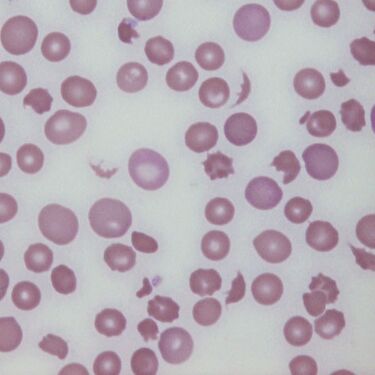 Keratocytes - haematologyetc.co.uk