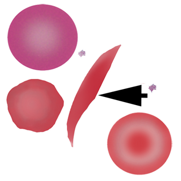 Sickle cells - haematologyetc.co.uk