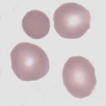 Spherocytes - haematologyetc.co.uk