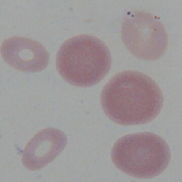 Dimorphic - haematologyetc.co.uk