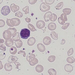Fragmented cells - haematologyetc.co.uk