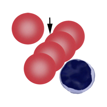 Rouleaux - haematologyetc.co.uk