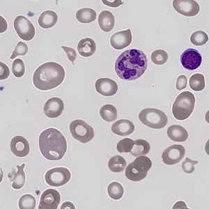 Fragmented cells - haematologyetc.co.uk