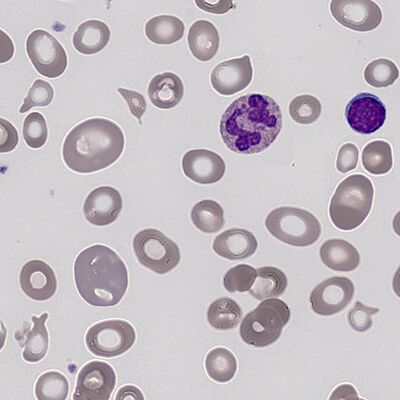 Fragmented cells - haematologyetc.co.uk