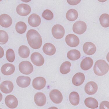 Ovalocytes - haematologyetc.co.uk