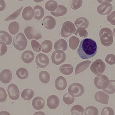 Sickle cells - haematologyetc.co.uk
