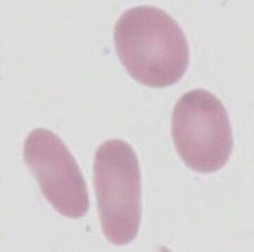 Elliptocytes - haematologyetc.co.uk