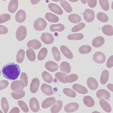 Elliptocytes - haematologyetc.co.uk