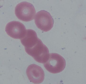 Rouleaux - haematologyetc.co.uk