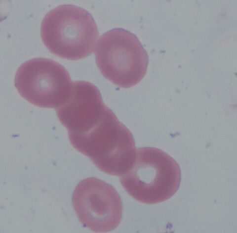 Rouleaux - haematologyetc.co.uk