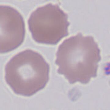 Echinocytes - haematologyetc.co.uk