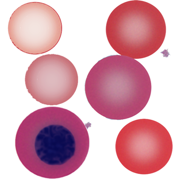 Anisochromia - haematologyetc.co.uk