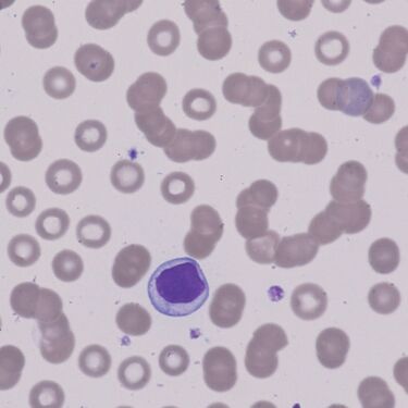 Rouleaux - haematologyetc.co.uk