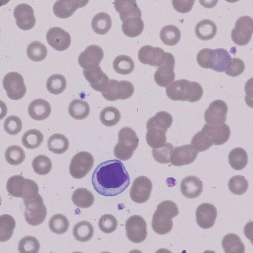 Rouleaux - haematologyetc.co.uk