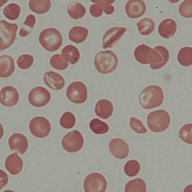 Haemoglobin crystals - haematologyetc.co.uk