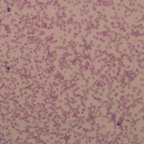 Agglutination - haematologyetc.co.uk