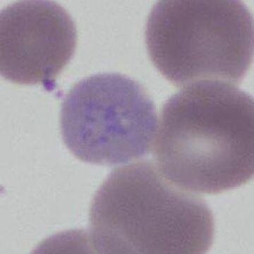 Cabot rings - haematologyetc.co.uk