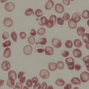 Haemoglobin crystals - haematologyetc.co.uk