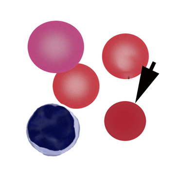 Spherocytes - haematologyetc.co.uk