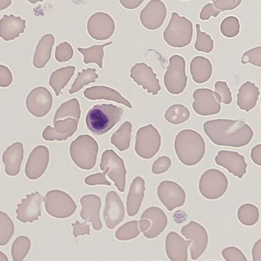 Elliptocytes - haematologyetc.co.uk
