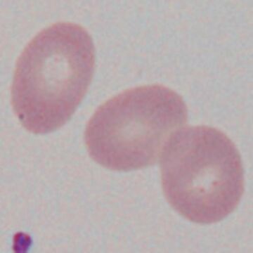 Ovalocytes - haematologyetc.co.uk