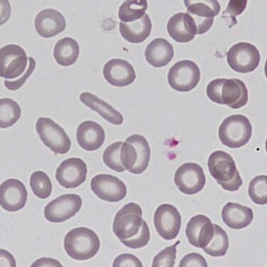 Pencil cells - haematologyetc.co.uk