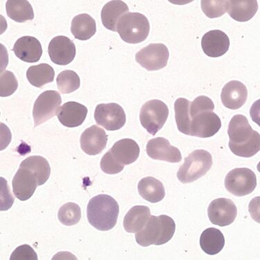 Spherocytes - haematologyetc.co.uk