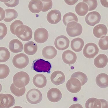 Target cells - haematologyetc.co.uk
