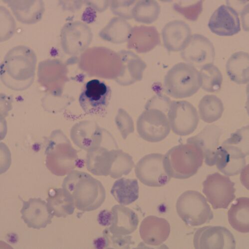 Anisochromia - haematologyetc.co.uk