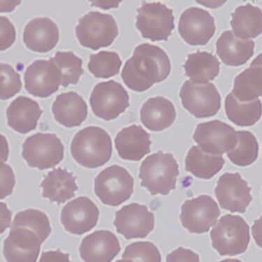 Echinocytes - haematologyetc.co.uk