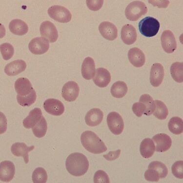 Ovalocytes - haematologyetc.co.uk