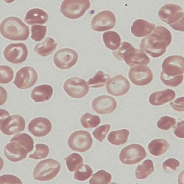 Irregularly contracted cells - haematologyetc.co.uk