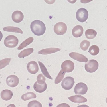 Sickle cells - haematologyetc.co.uk