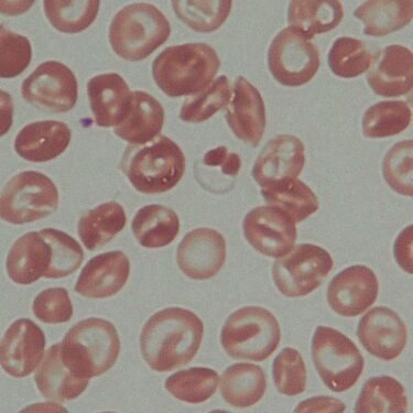 Haemoglobin crystals - haematologyetc.co.uk