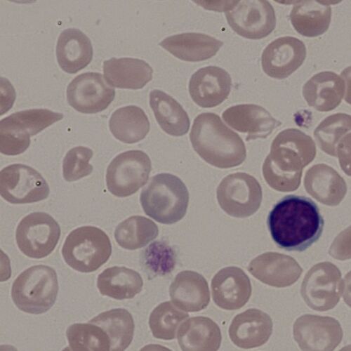 Boat-shaped cells - haematologyetc.co.uk