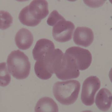 Agglutination - haematologyetc.co.uk