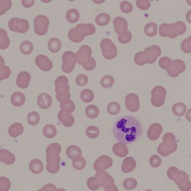 Rouleaux - haematologyetc.co.uk