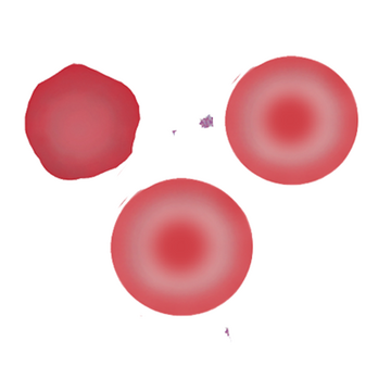 Target cells - haematologyetc.co.uk