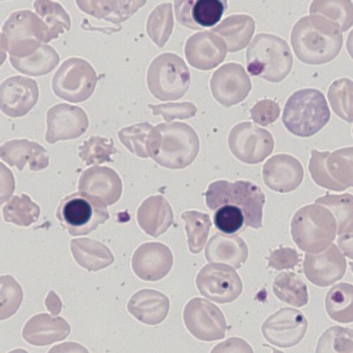 Target cells - haematologyetc.co.uk