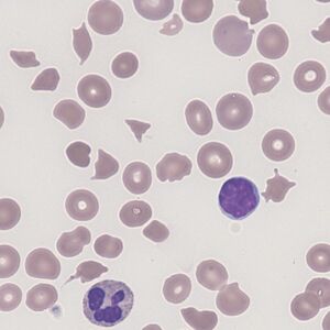 Fragmented cells - haematologyetc.co.uk